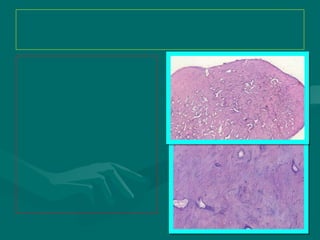 Jaw bone disaese ii | PPT