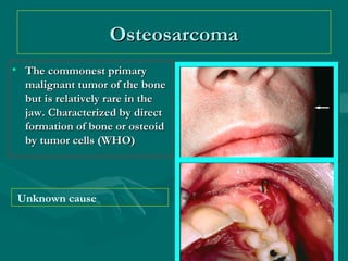 Jaw bone disaese ii | PPT