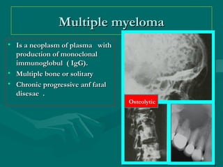 Jaw bone disaese ii | PPT