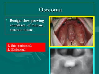 Jaw bone disaese ii | PPT