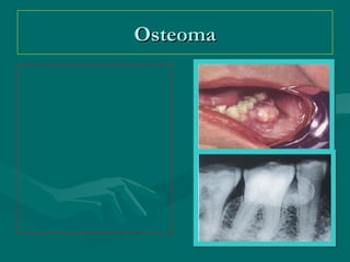 Jaw bone disaese ii | PPT
