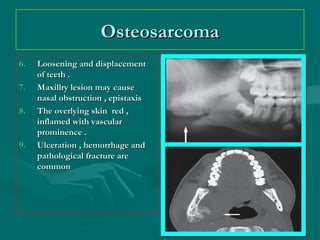Osteosarcoma Jaw X Ray