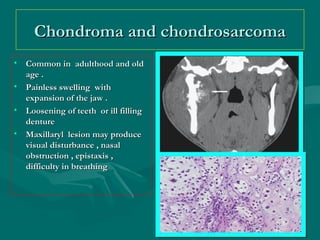 Chondrosarcoma Jaw