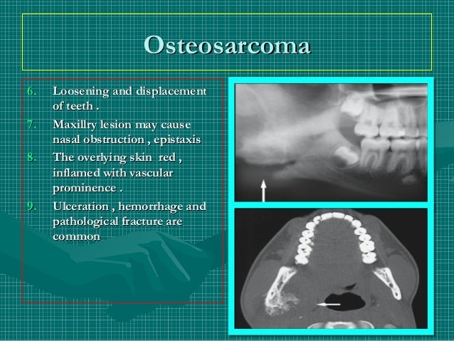 Jaw bone disaese ii