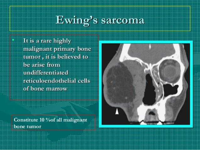 Ewing Sarcoma Jaw Treatment Of Mandibular Ewing's Sarcoma In A Child: