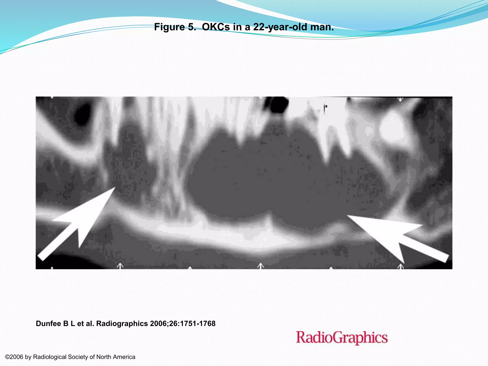 Jaw bone lesions | PPTX