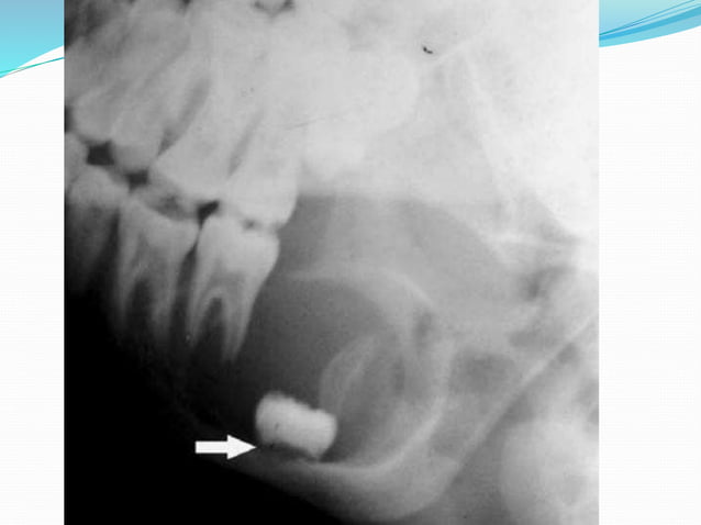 Jaw bone lesions | PPTX | Dental Health | Diseases and Conditions