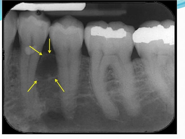 Jaw bone lesions | PPTX | Dental Health | Diseases and Conditions