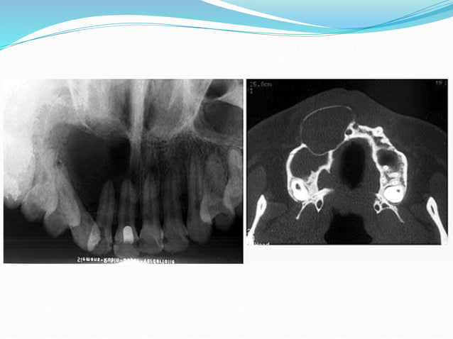 Jaw bone lesions | PPTX | Dental Health | Diseases and Conditions