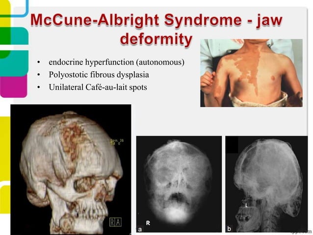 Jaw deformities | PPT