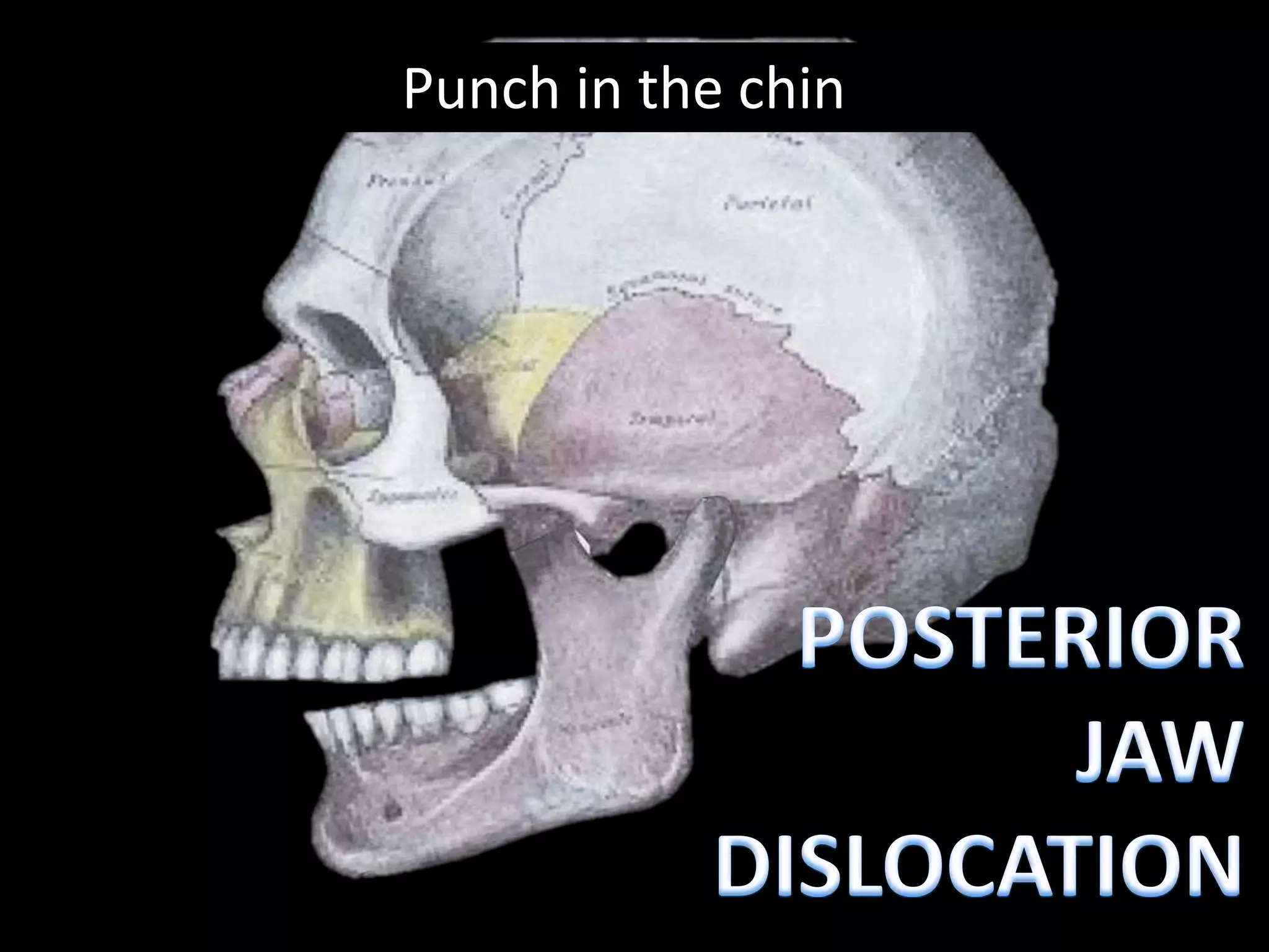 Jaw dislocation | PPTX