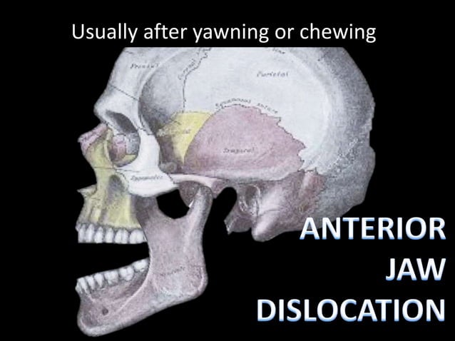 Jaw dislocation | PPTX | First Aid | Injuries