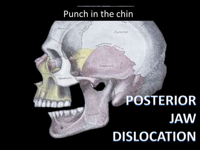 Jaw dislocation | PPTX | First Aid | Injuries
