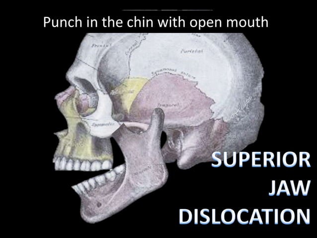 Jaw dislocation | PPTX | First Aid | Injuries