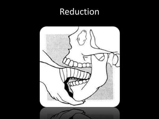 Jaw dislocation | PPT