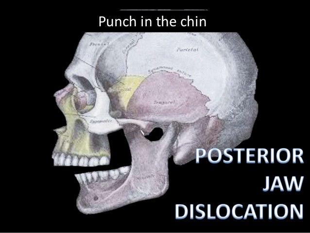 Jaw dislocation