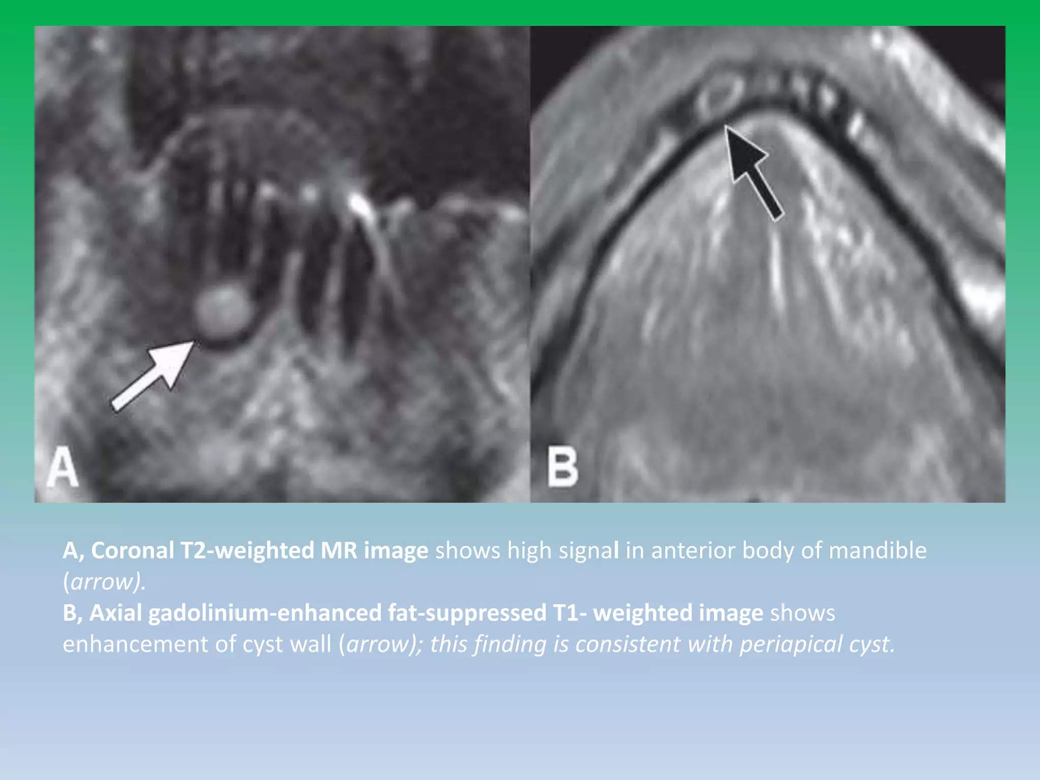 Jaw lesion radiology ppt | PPTX