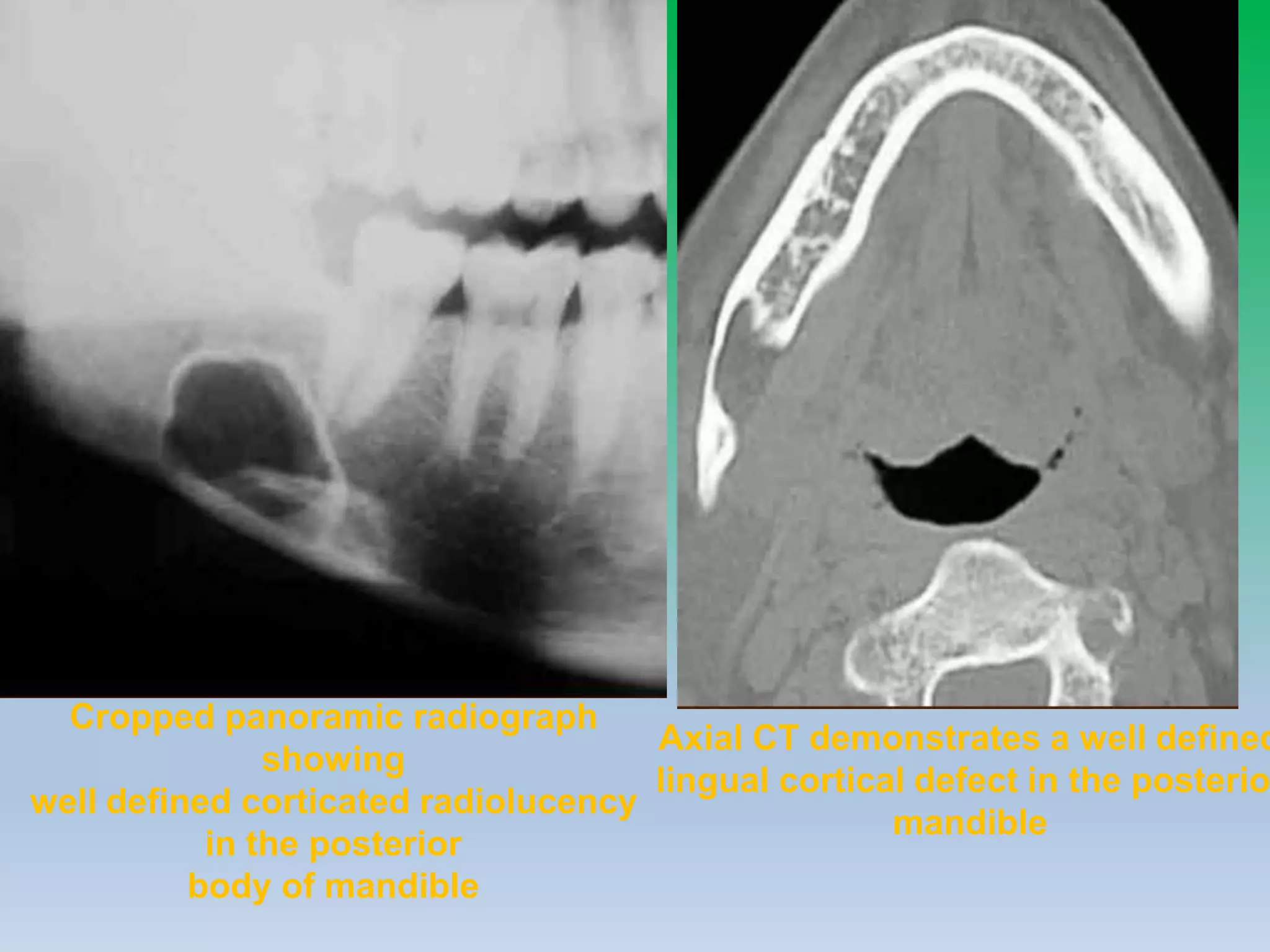Jaw lesion radiology ppt | PPTX