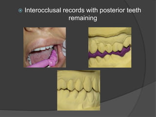 Jaw relation in rpd | PPTX