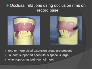 Jaw relation in rpd | PPTX