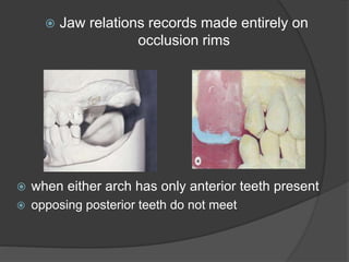 Jaw relation in rpd | PPTX