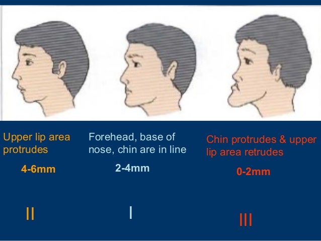 Jaw relation