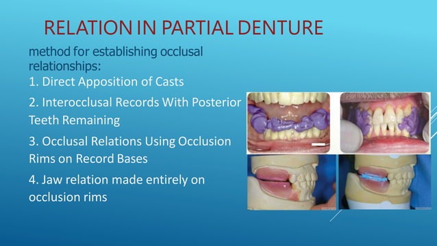 jaw relation in complete and partial denture | PPTX | Dental Health | Diseases and Conditions