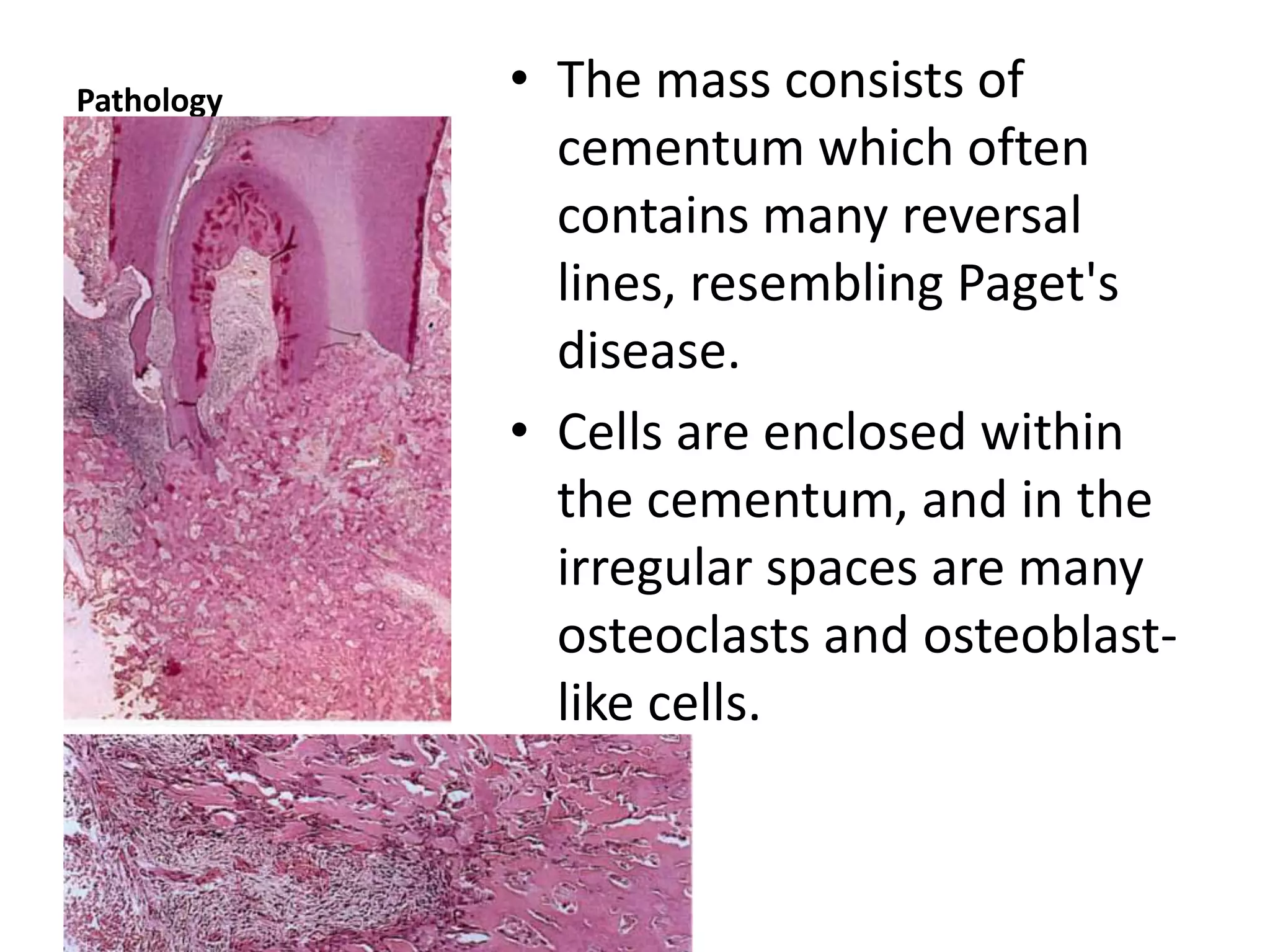 Jaw tumors beningn and malignant | PPTX