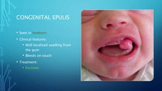 Jaw tumours | PPTX