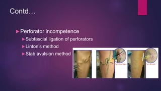 Varicose Vein | PPTX