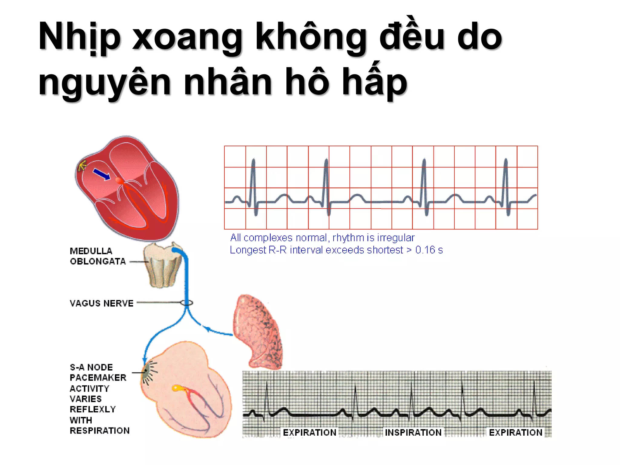 CÁC DẠNG NHỊP TRONG ECG | PDF