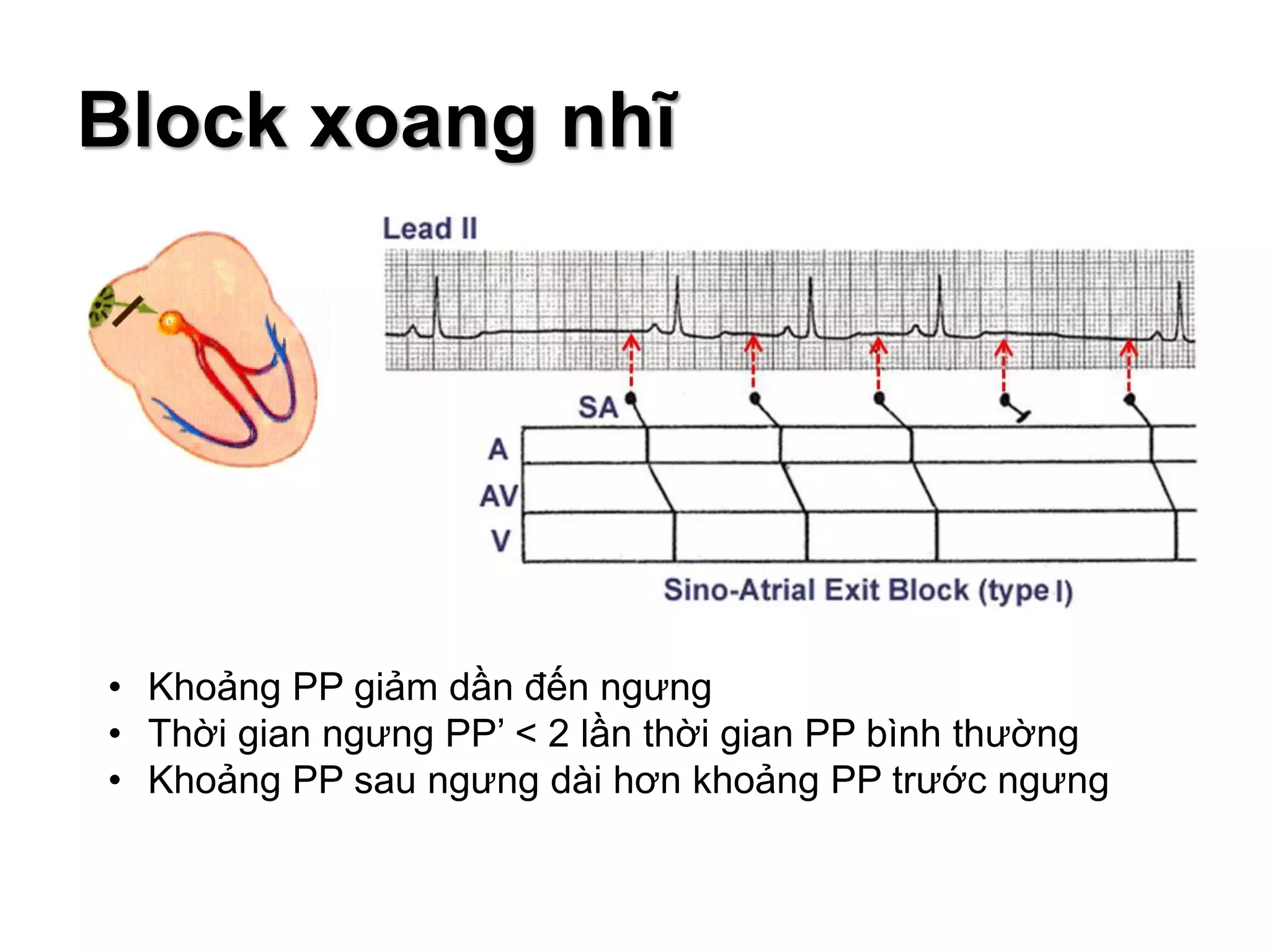 CÁC DẠNG NHỊP TRONG ECG | PDF