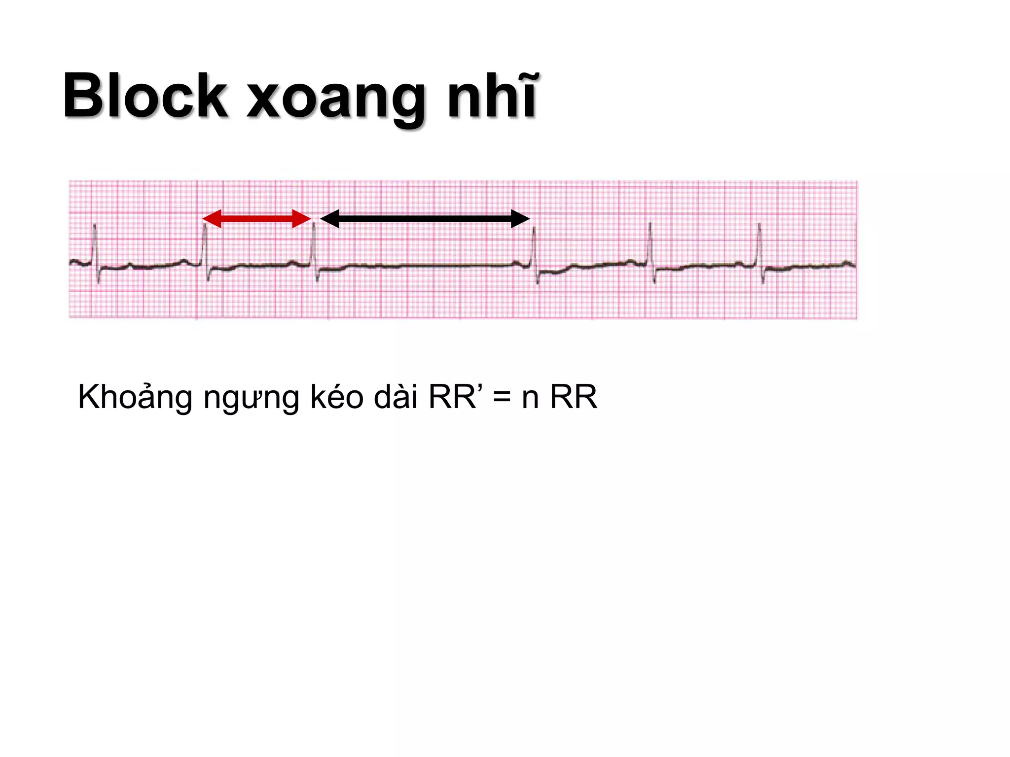 CÁC DẠNG NHỊP TRONG ECG | PDF