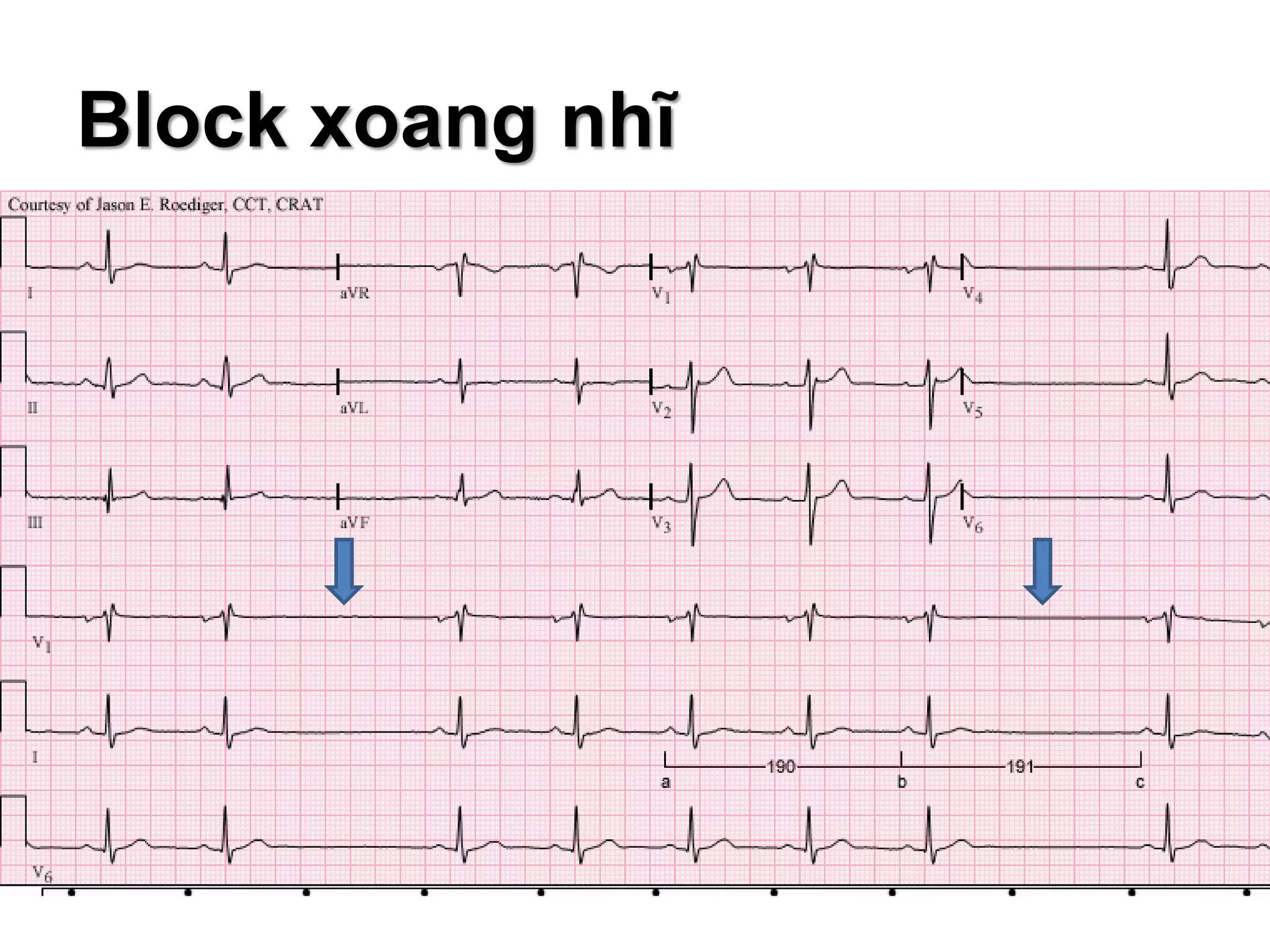 CÁC DẠNG NHỊP TRONG ECG | PDF
