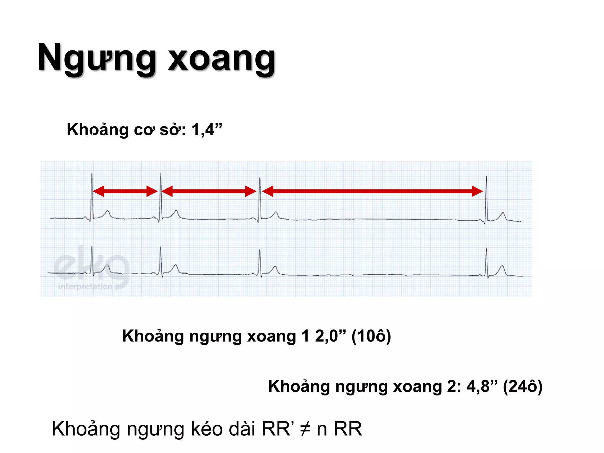CÁC DẠNG NHỊP TRONG ECG | PDF