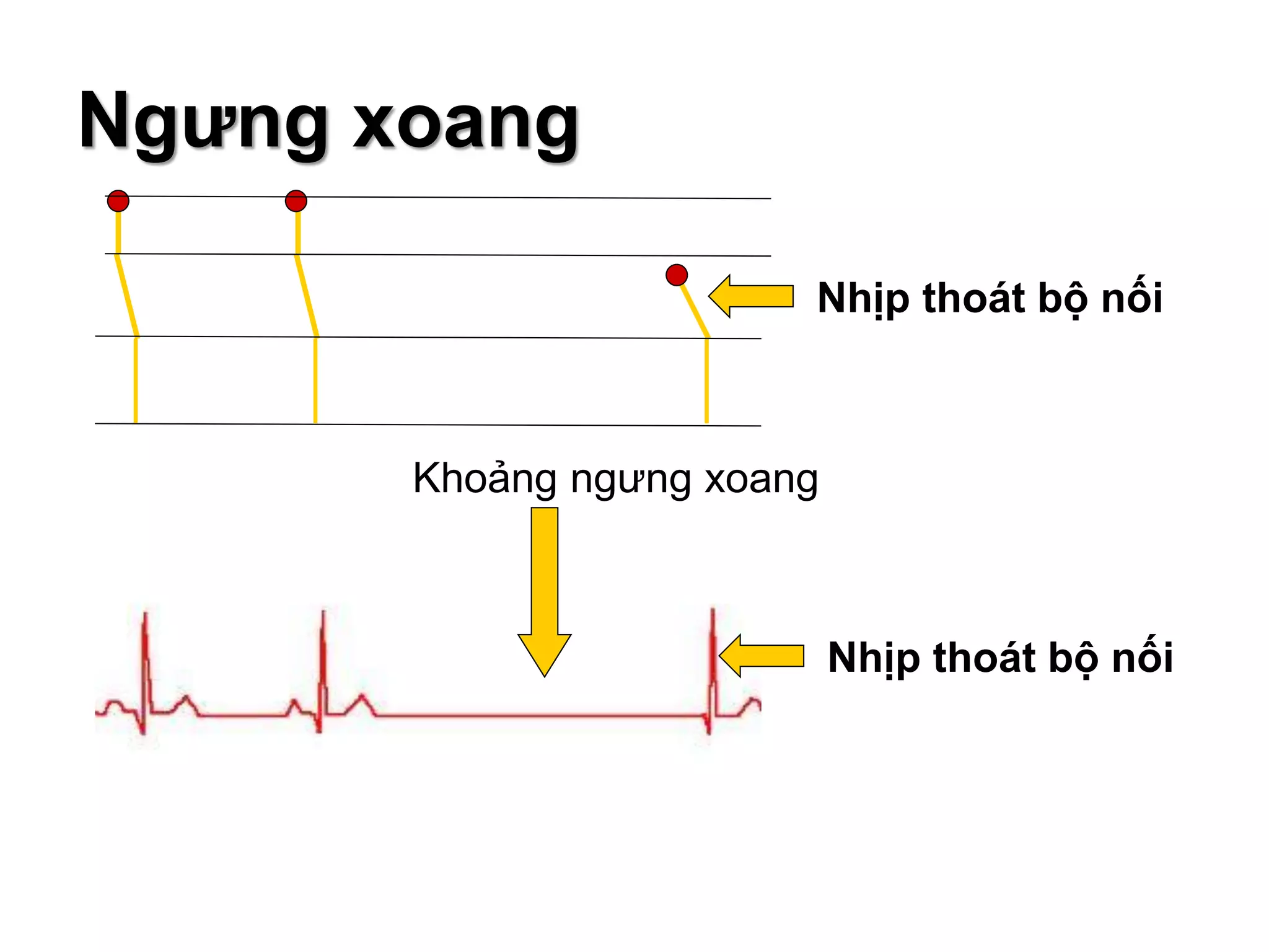 CÁC DẠNG NHỊP TRONG ECG | PDF