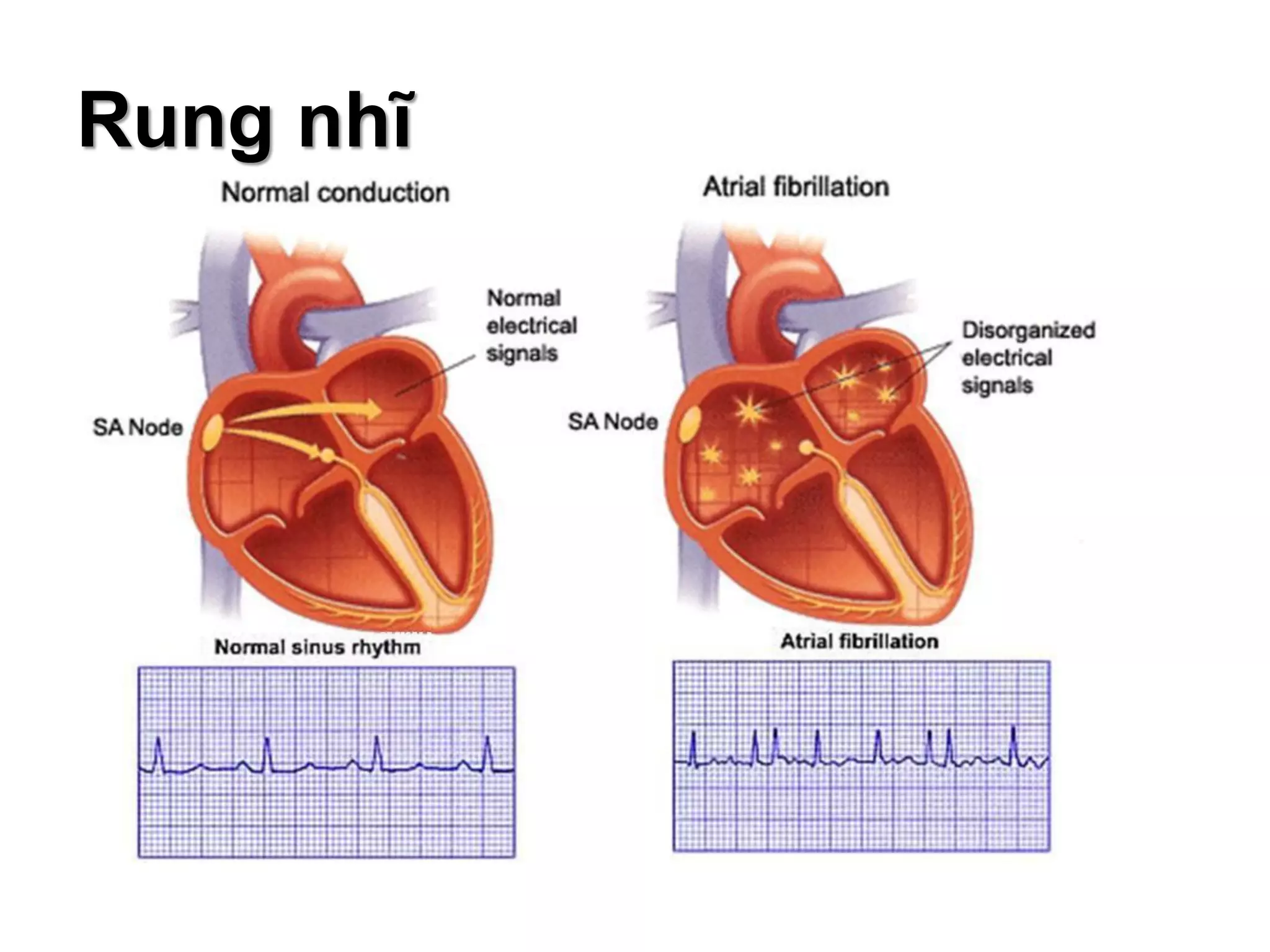 CÁC DẠNG NHỊP TRONG ECG | PDF