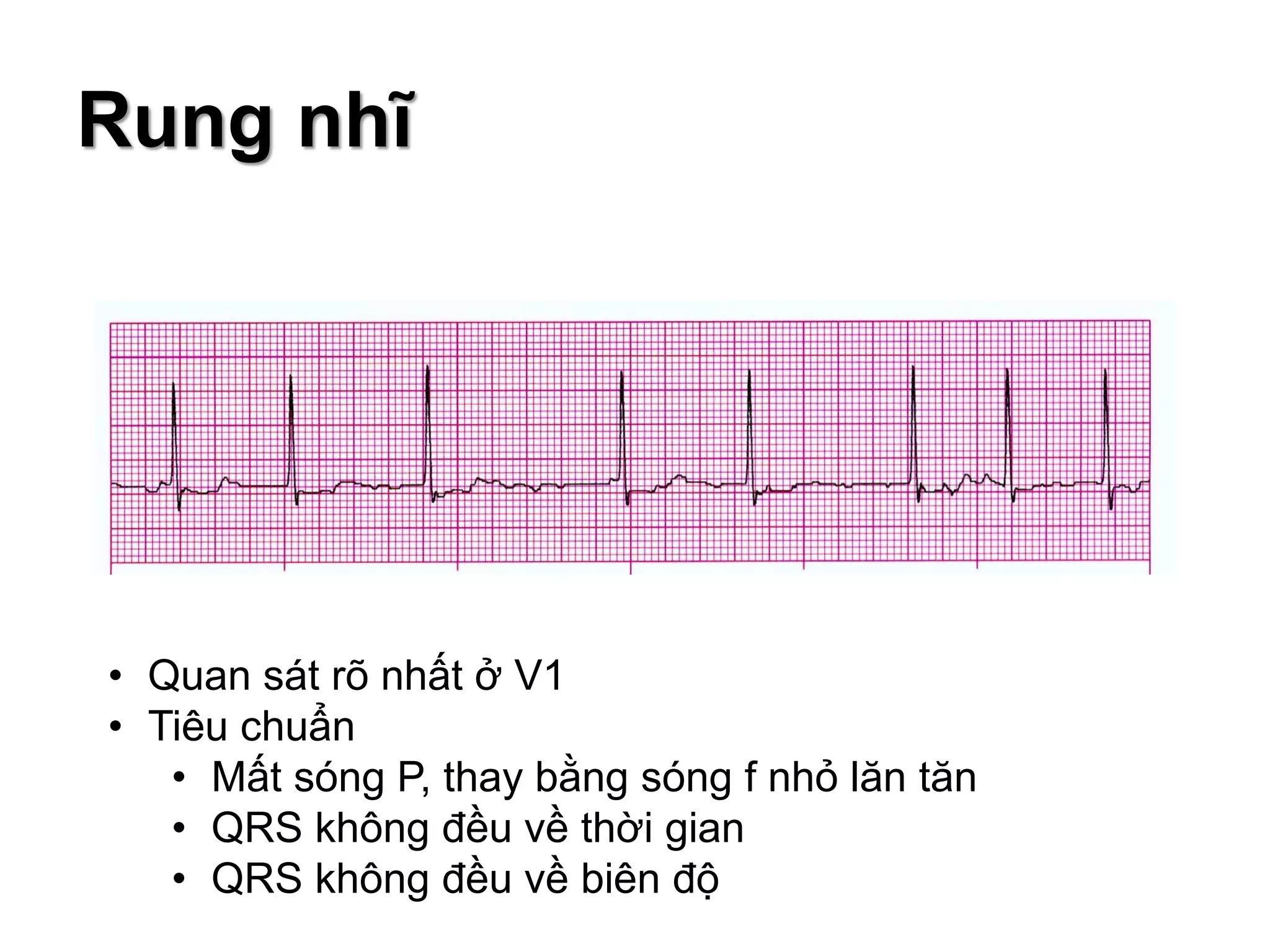CÁC DẠNG NHỊP TRONG ECG | PDF