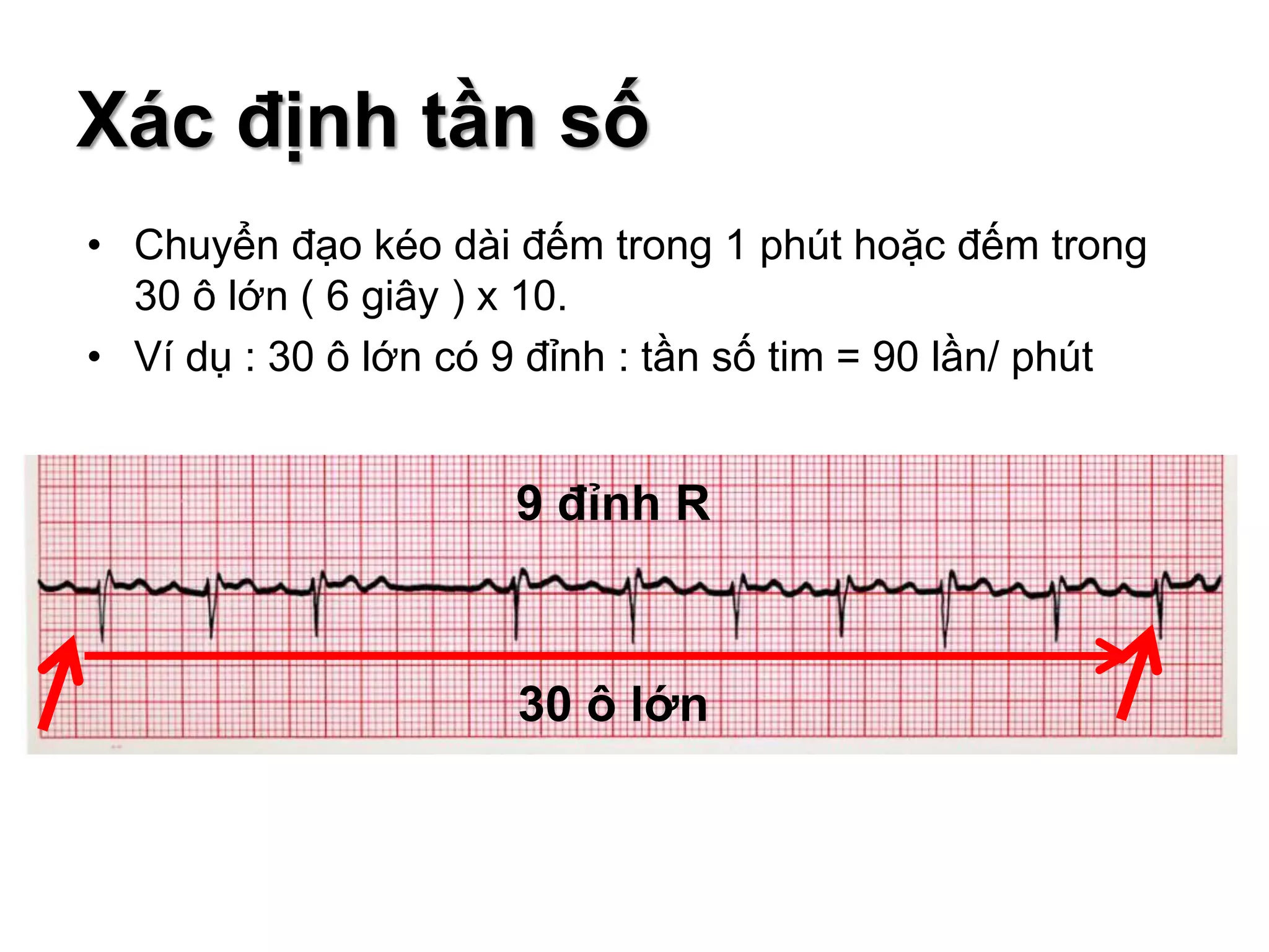 CÁC DẠNG NHỊP TRONG ECG | PDF