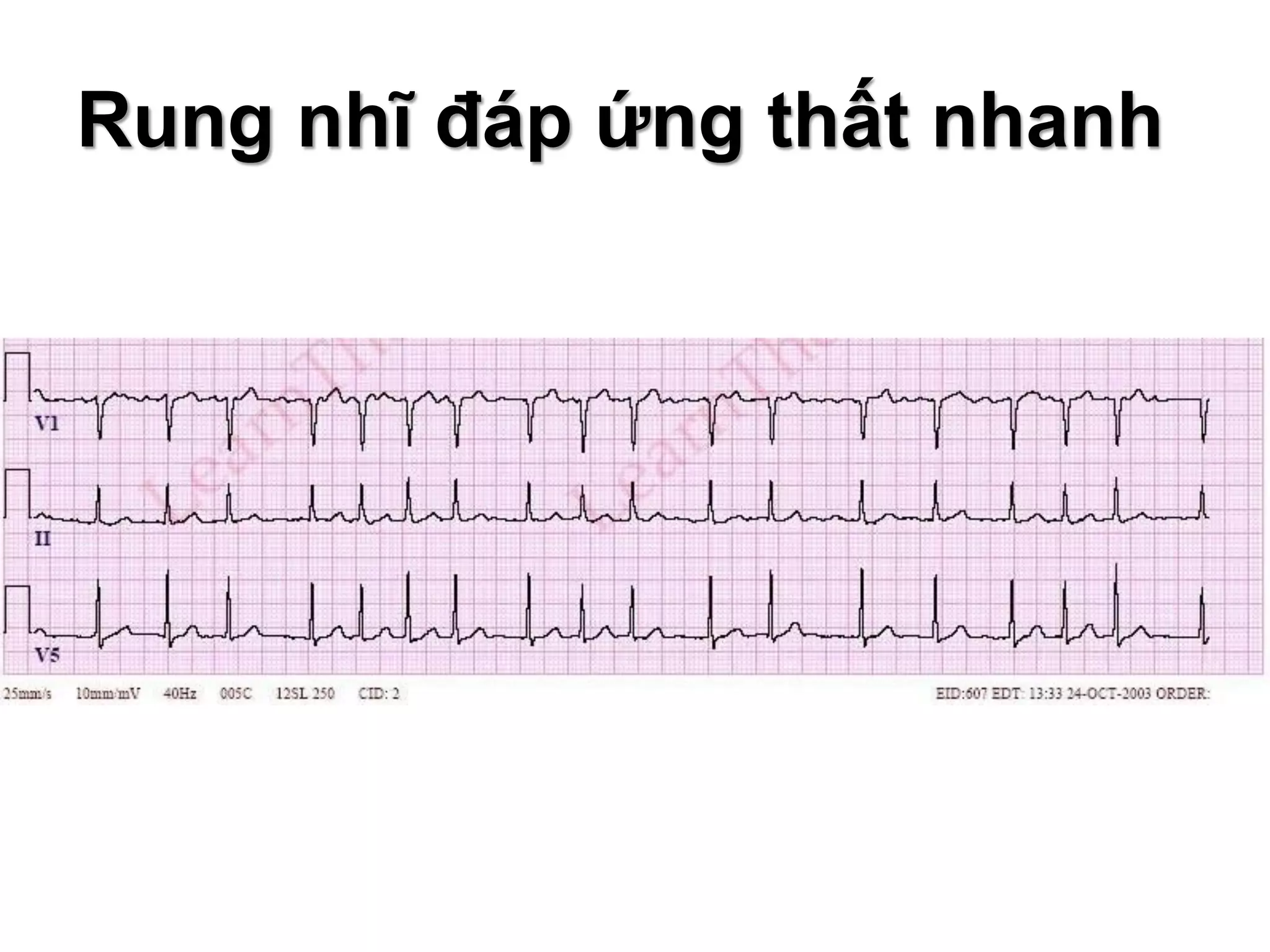 CÁC DẠNG NHỊP TRONG ECG | PDF