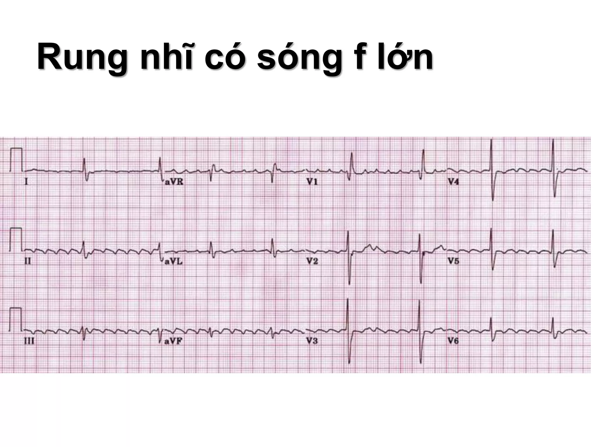 CÁC DẠNG NHỊP TRONG ECG | PDF