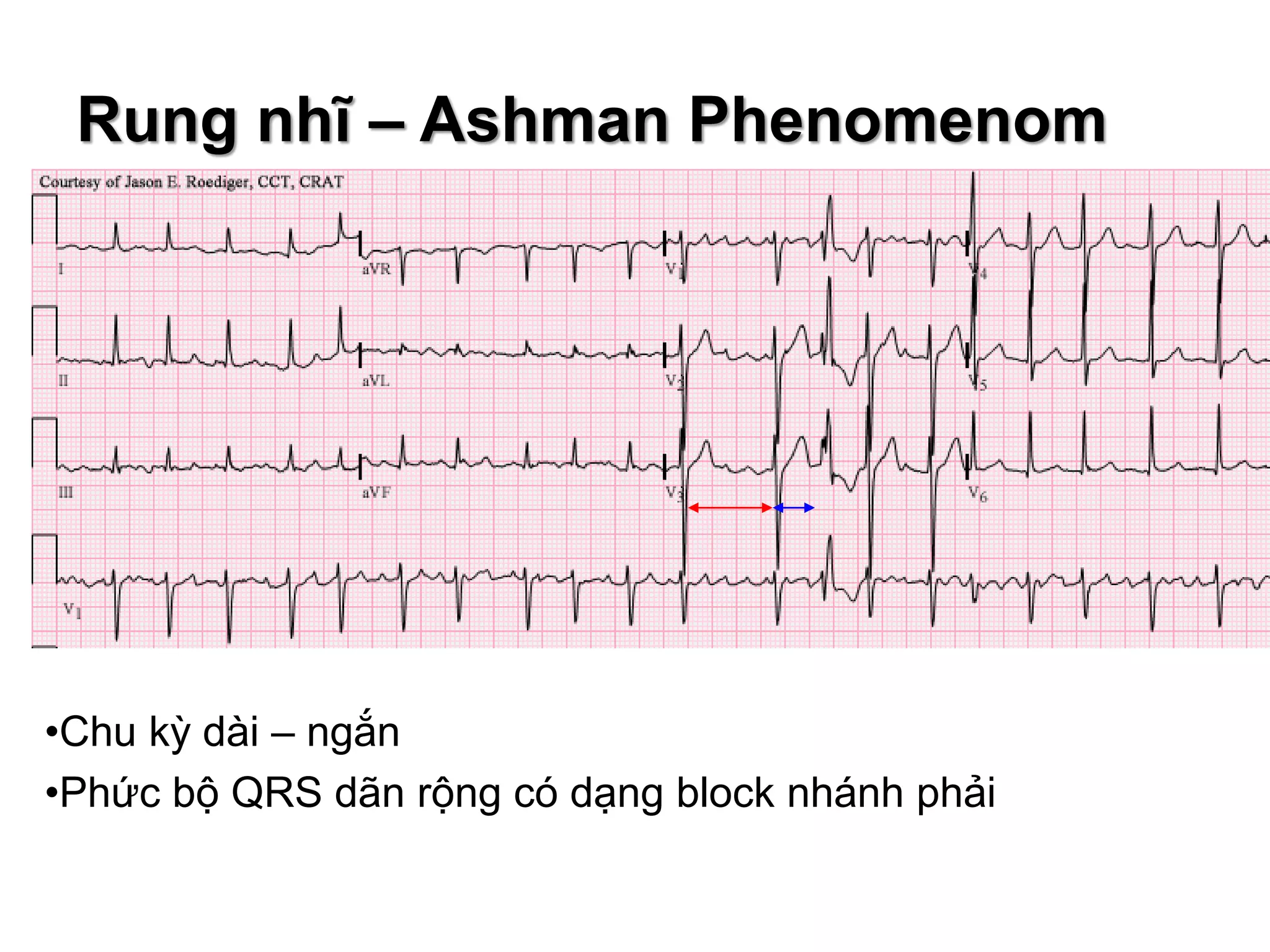 CÁC DẠNG NHỊP TRONG ECG | PDF