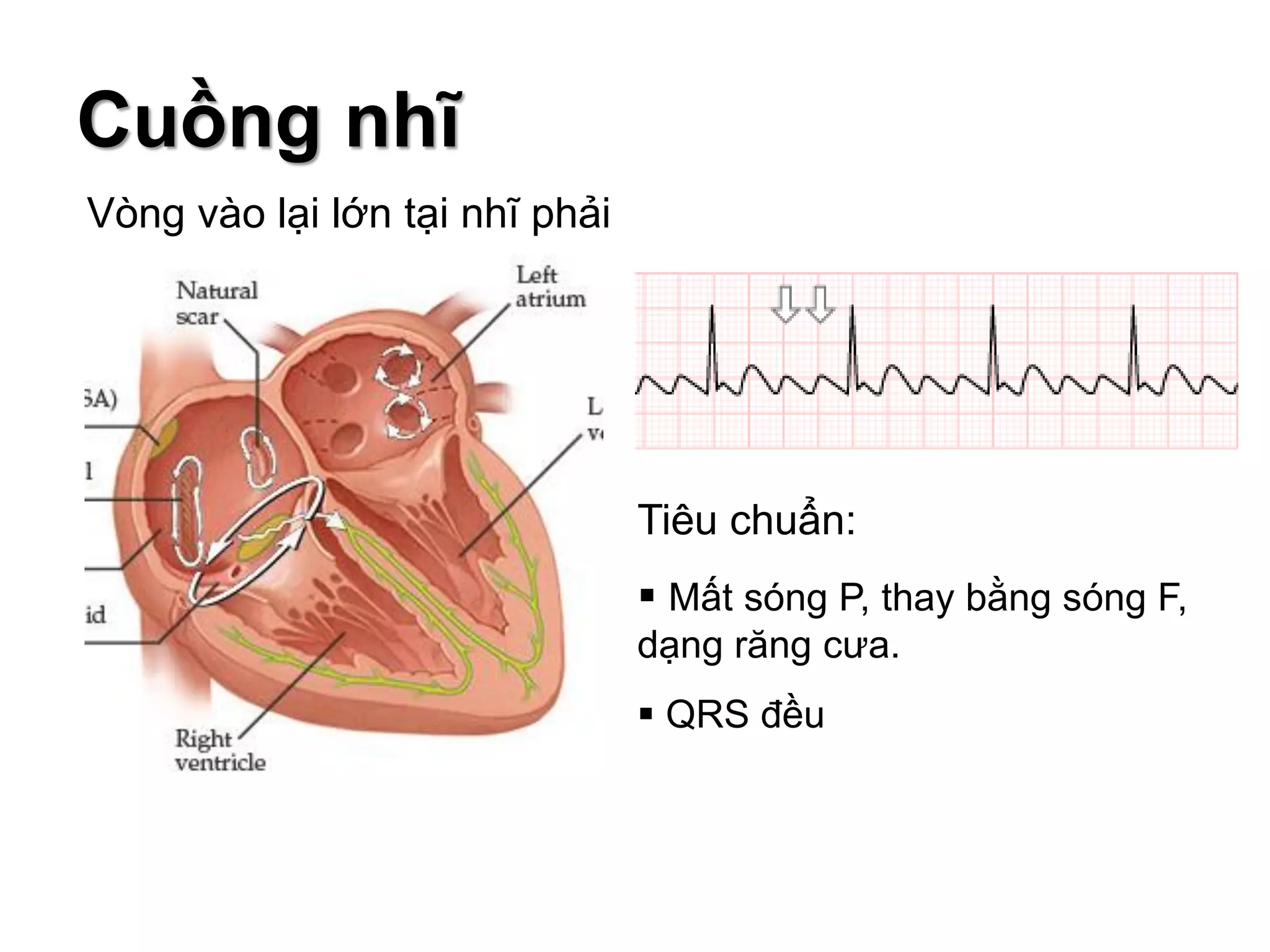 CÁC DẠNG NHỊP TRONG ECG | PDF