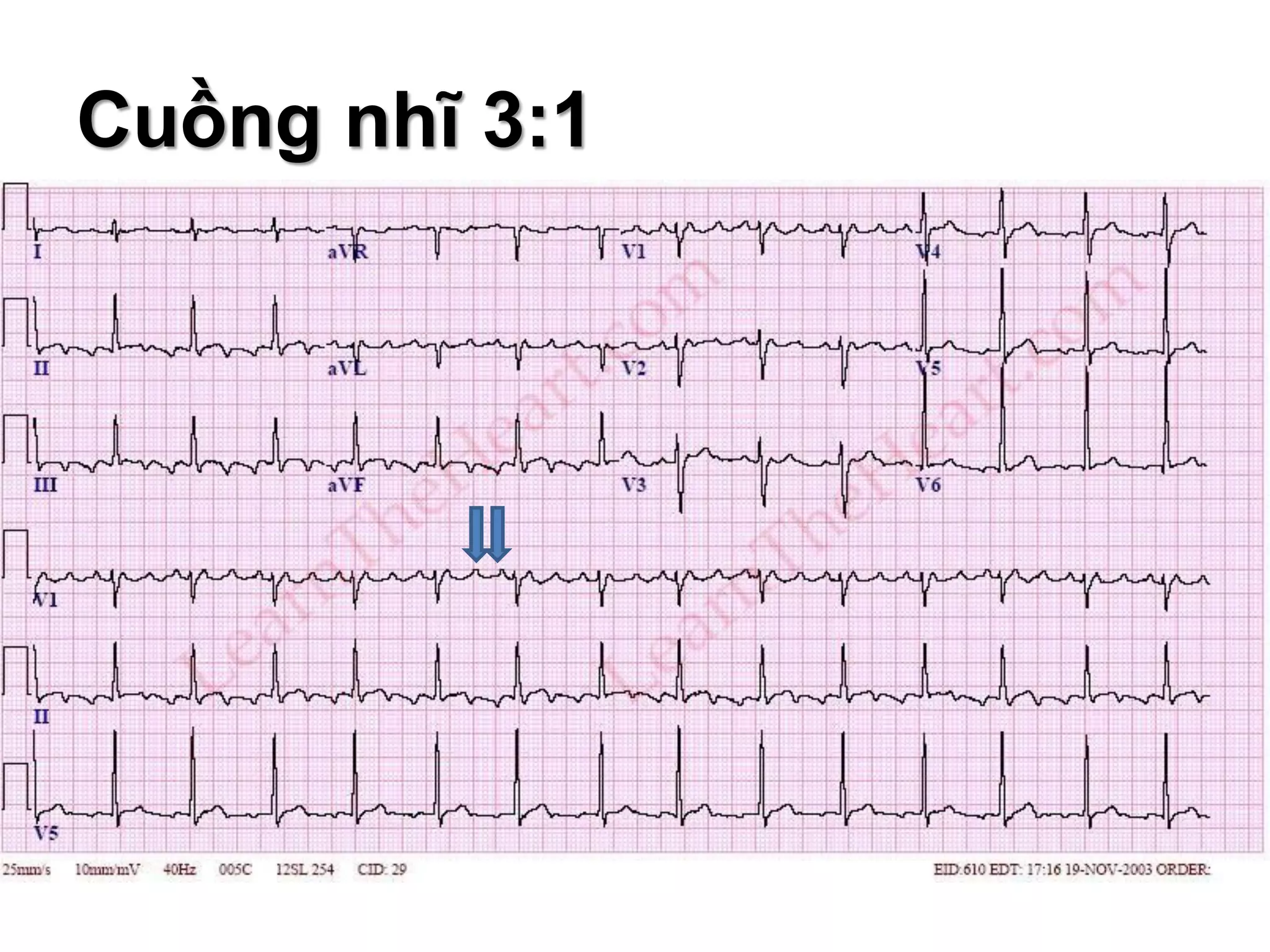 CÁC DẠNG NHỊP TRONG ECG | PDF