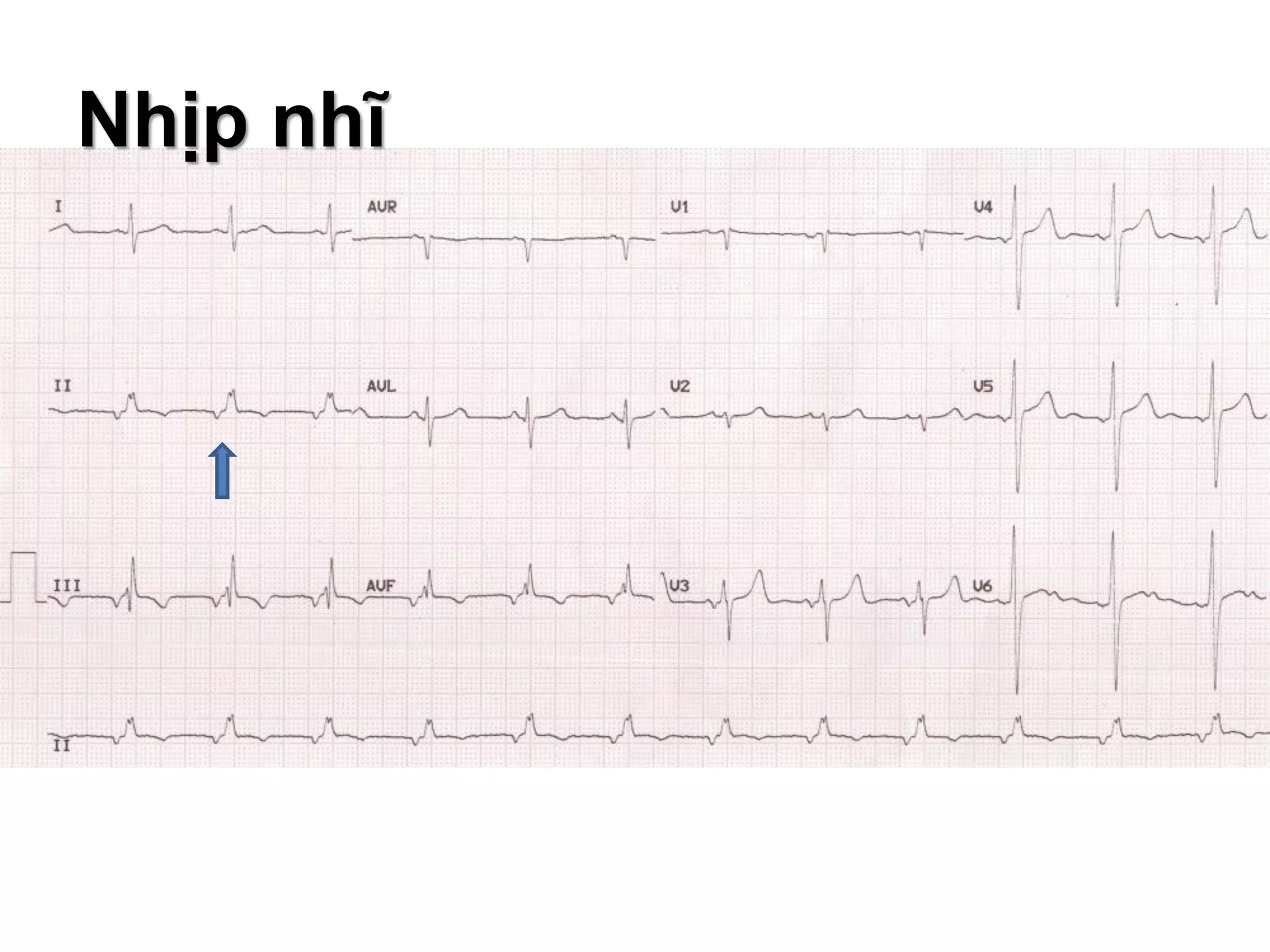 CÁC DẠNG NHỊP TRONG ECG | PDF