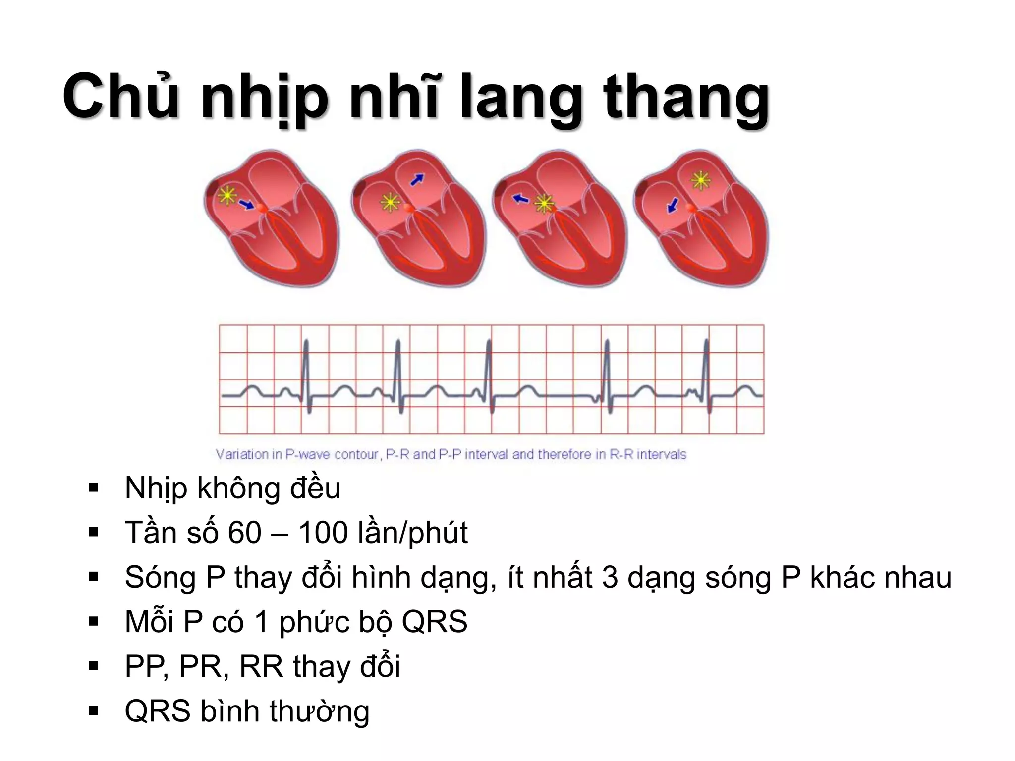 CÁC DẠNG NHỊP TRONG ECG | PDF