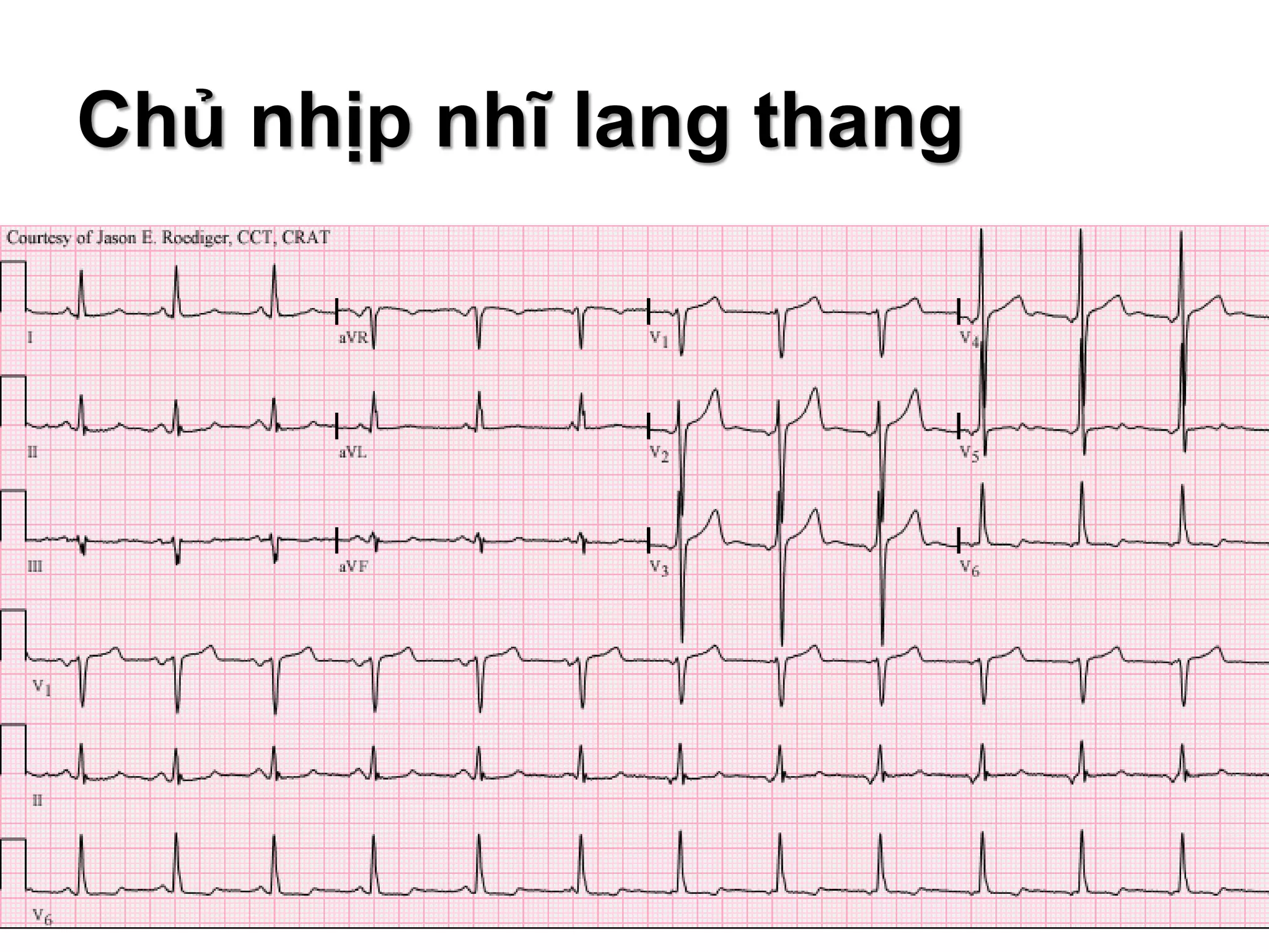 CÁC DẠNG NHỊP TRONG ECG | PDF