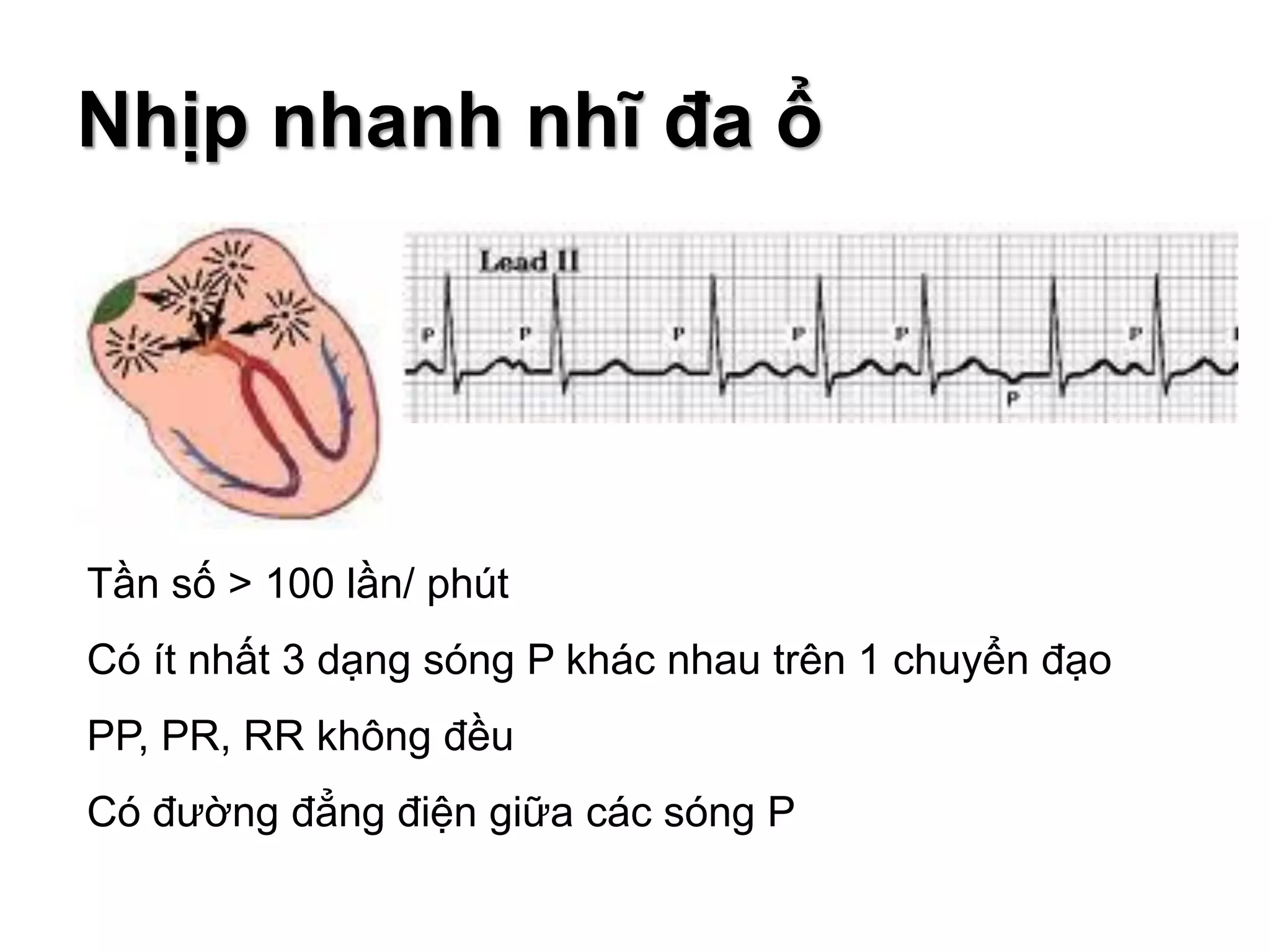 CÁC DẠNG NHỊP TRONG ECG | PDF