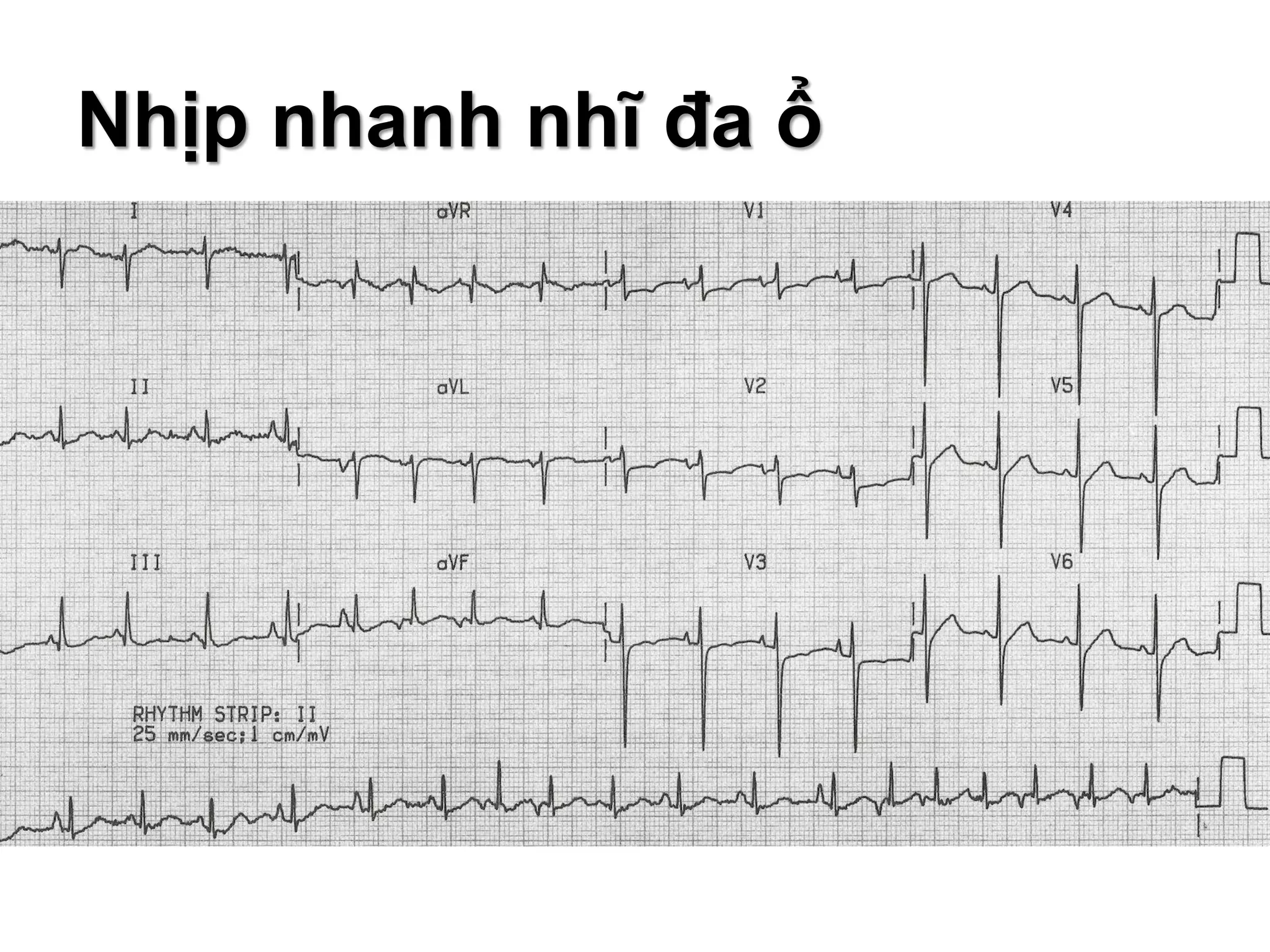 CÁC DẠNG NHỊP TRONG ECG | PDF