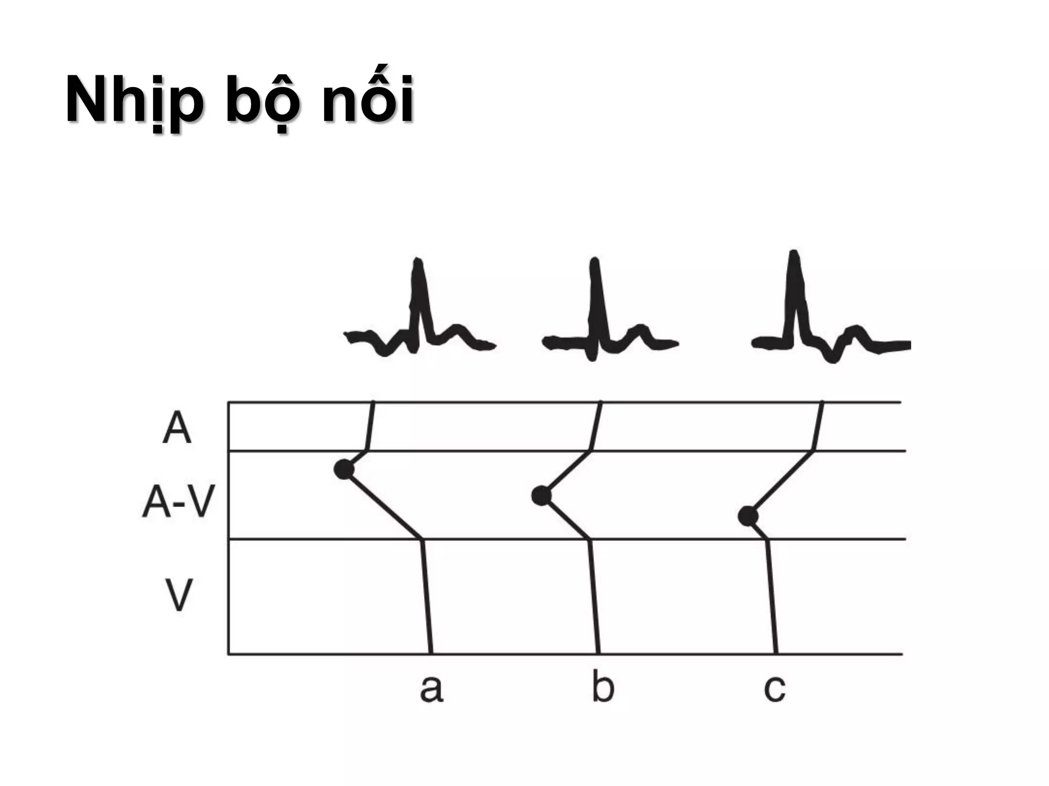 CÁC DẠNG NHỊP TRONG ECG | PDF